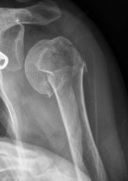 Treating a Broken Proximal Humerus: The Options - Orthopaedic Surgeon ...
