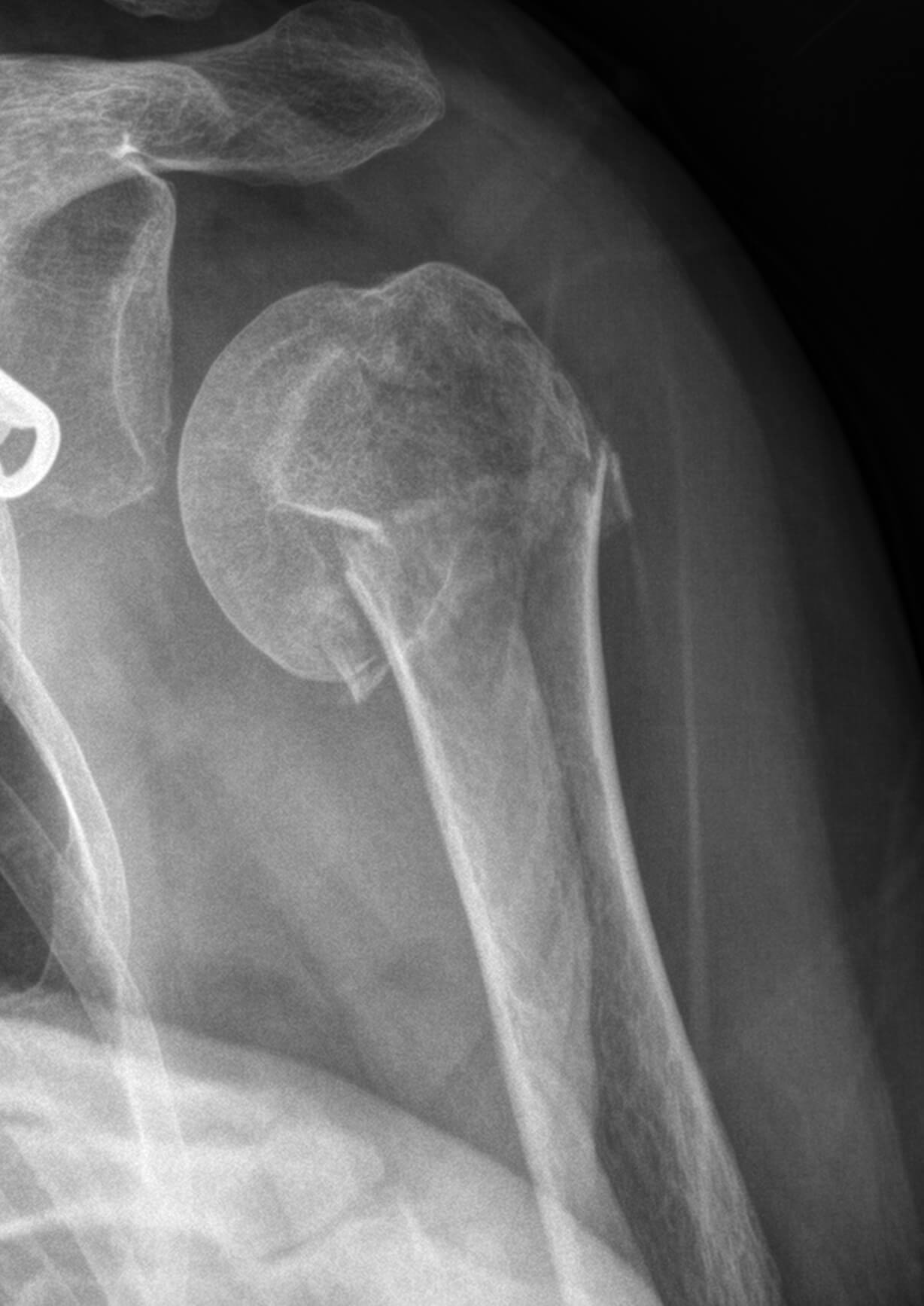 Treating a Broken Proximal Humerus: The Options - Orthopaedic Surgeon ...
