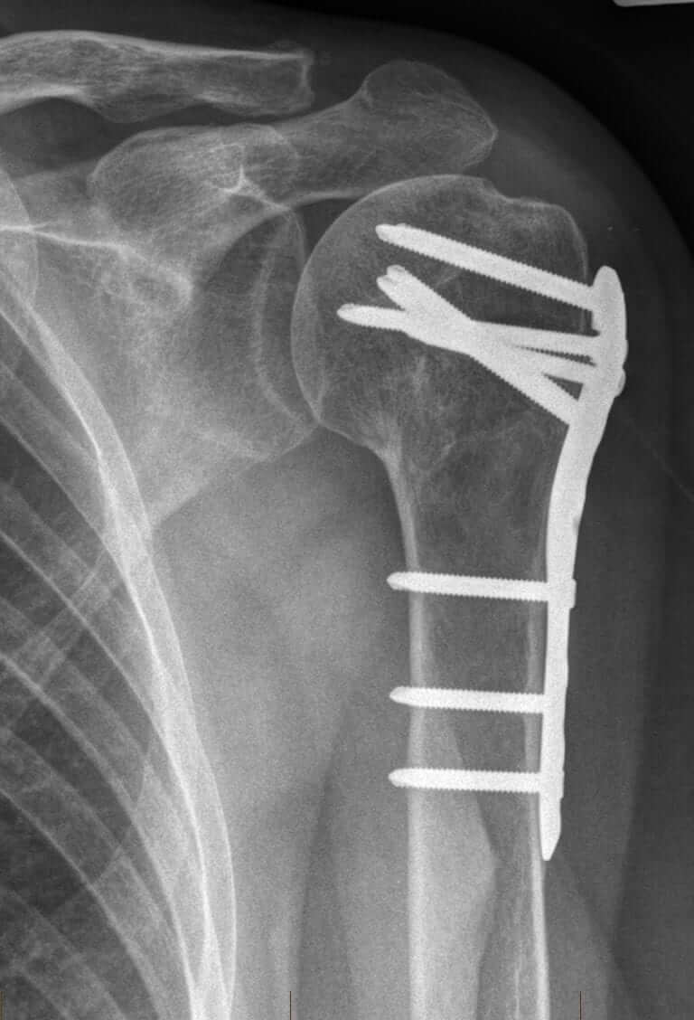 Treating a Broken Proximal Humerus: The Options - Orthopaedic Surgeon ...