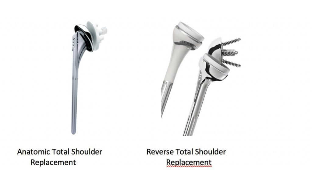 Shoulder Reconstruction vs Replacement: Explained by an Adelaide ...