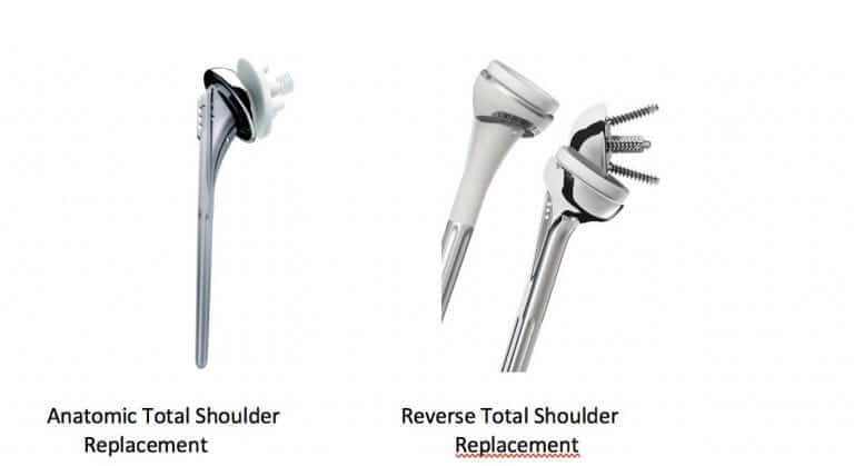 Shoulder Reconstruction vs Replacement: Explained by an Adelaide ...