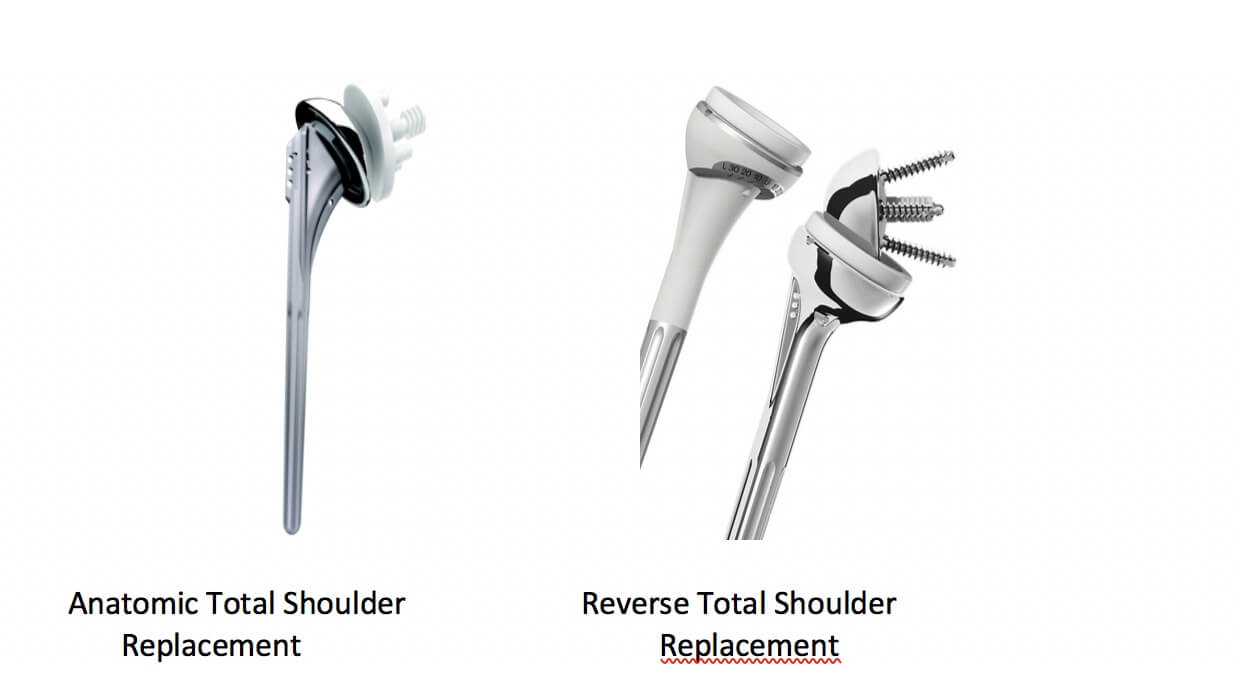 Shoulder Reconstruction vs Replacement: Explained by an Adelaide ...