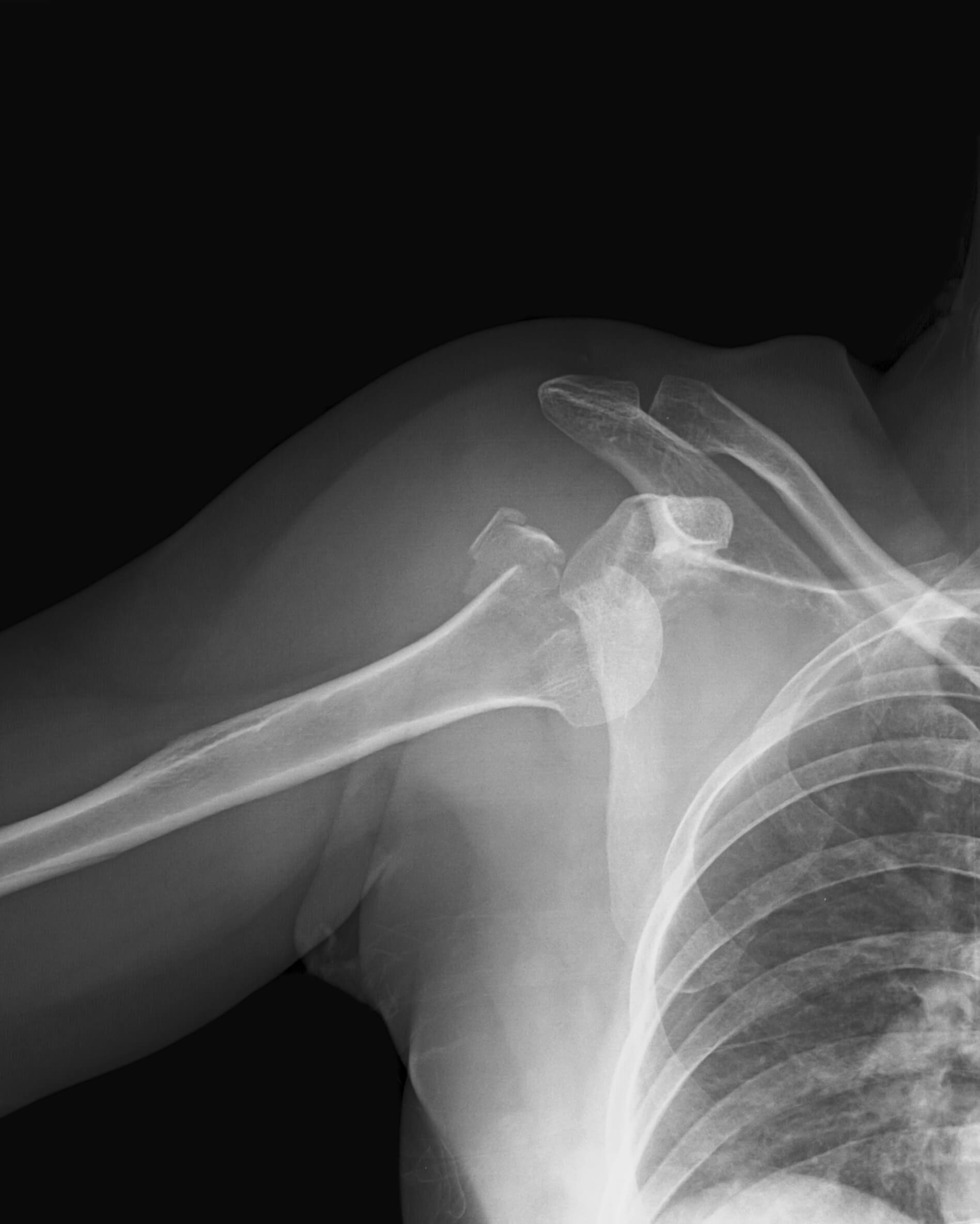 Treating a Broken Proximal Humerus: The Options - Orthopaedic Surgeon ...