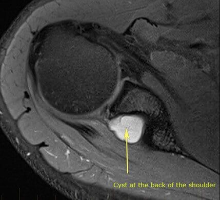 Shoulder Labral Tears: Know How to Identify and Treat - Orthopaedic ...