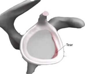 Shoulder Labral Tears: Know How to Identify and Treat - Orthopaedic ...
