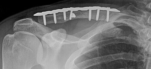 Managing Clavicle Fractures After Trauma - Orthopaedic Surgeon Adelaide