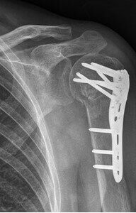 Treating a Broken Proximal Humerus: The Options - Orthopaedic Surgeon ...