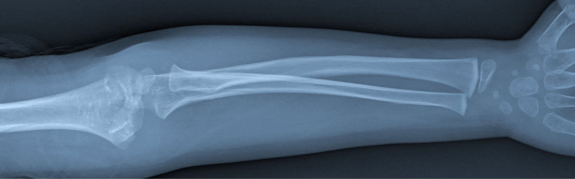 Elbow & Radial Head Fractures - Orthopaedic Surgeon Adelaide Providing ...