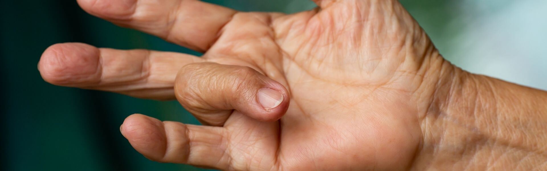 Trigger Finger: Causes, Symptoms & Treatments - Orthopaedic Surgeon ...