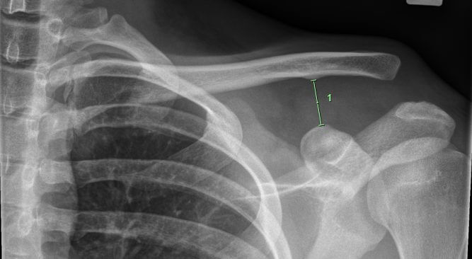 Acromio-Clavicular (AC) Joint Injuries - Orthopaedic Surgeon Adelaide ...