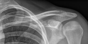 Acromio-Clavicular (AC) Joint Injuries - Orthopaedic Surgeon Adelaide ...