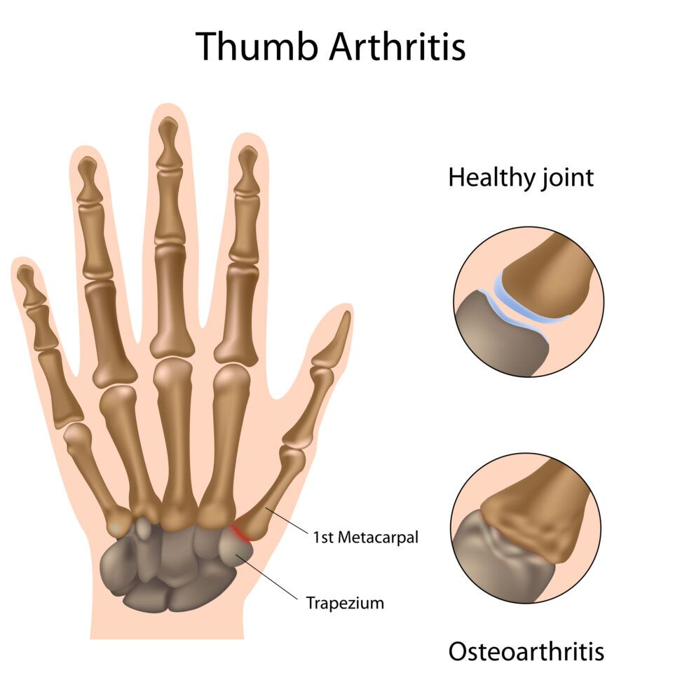 CMC Arthritis - Orthopaedic Surgeon Adelaide Providing Quality ...